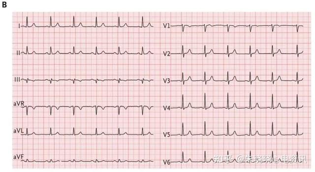 这几种情况可出现心电图 J 波 - 知乎