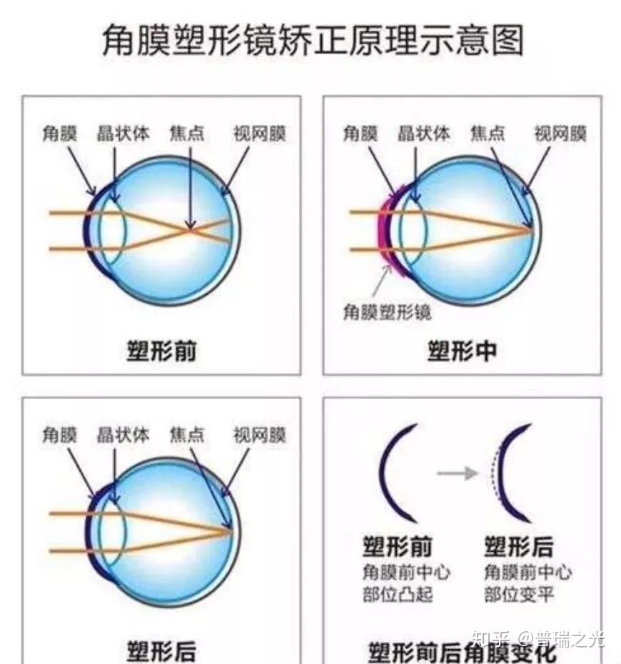 眼科科普丨带您全面了解角膜塑形镜 - 知乎