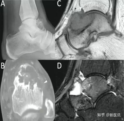 碎片陷落征(Fallen Fragment Sign)、骨母细胞瘤 - 知乎