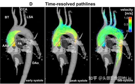 一起看懂4D FLOW MRI 参数（上） - 知乎