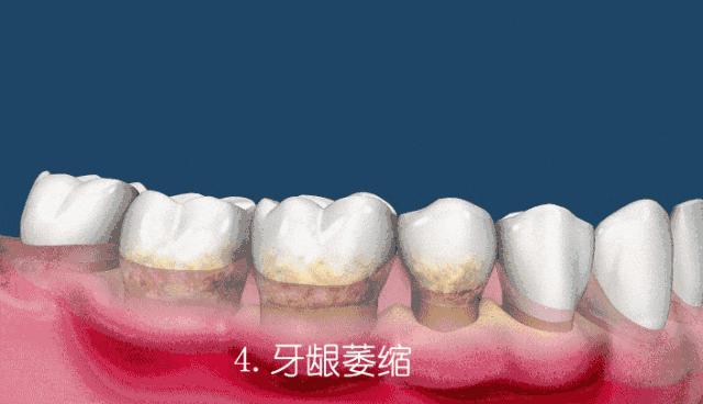 牙龈萎缩还能恢复吗?明确告诉你:不能! 知乎