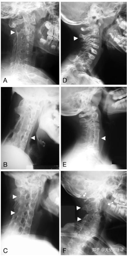 FOP患者的颈椎发育异常明显不同于Klippel-Feil综合征患者 - 知乎