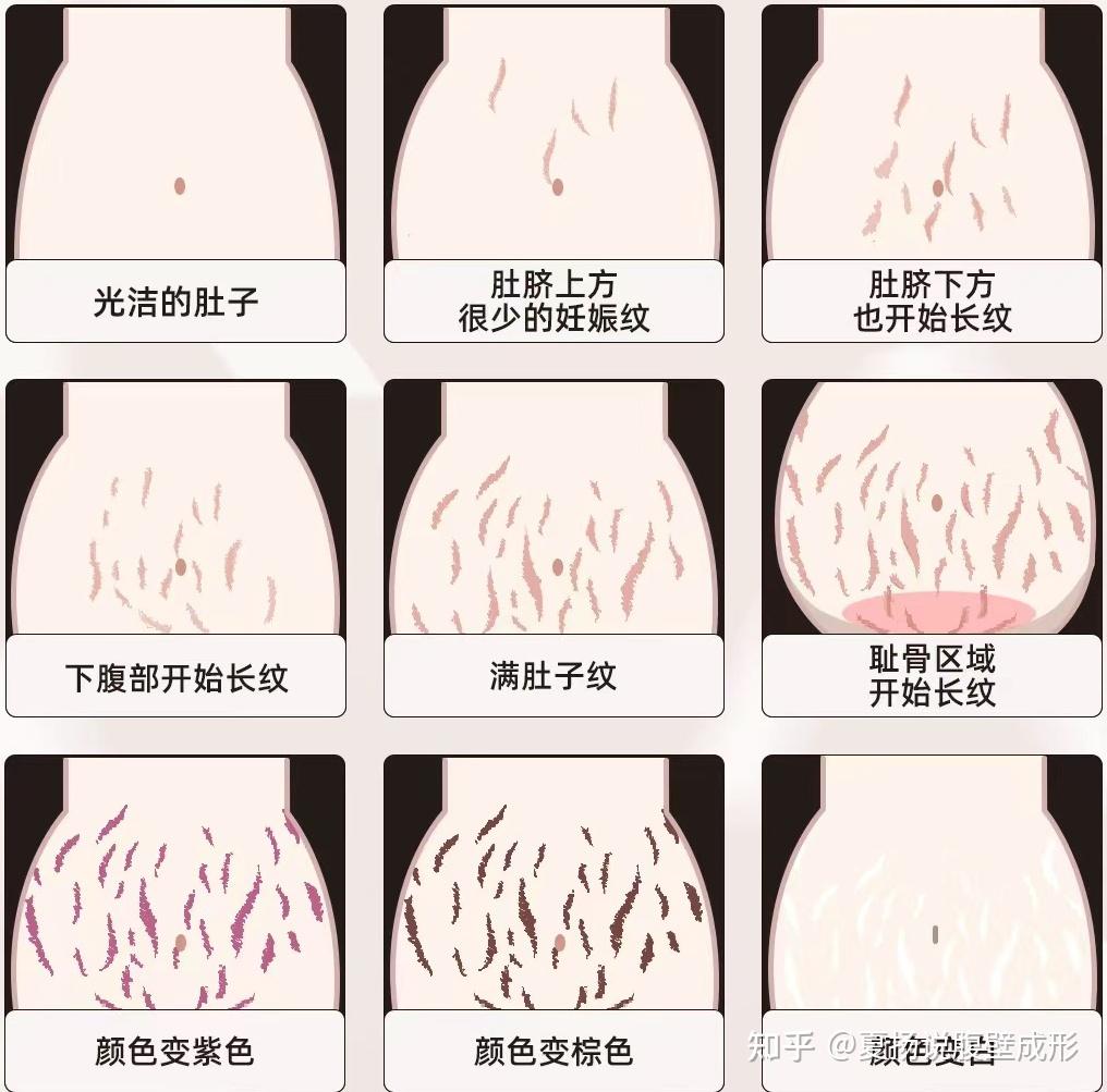 产后妊娠纹、肥胖纹、生长纹怎么办?不要慌!你可以这样拯救 知乎