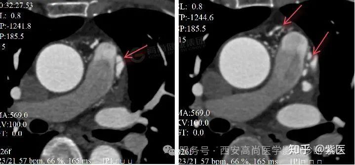 无明显不适偶感胸闷，CTA发现冠状动脉瘘 - 知乎