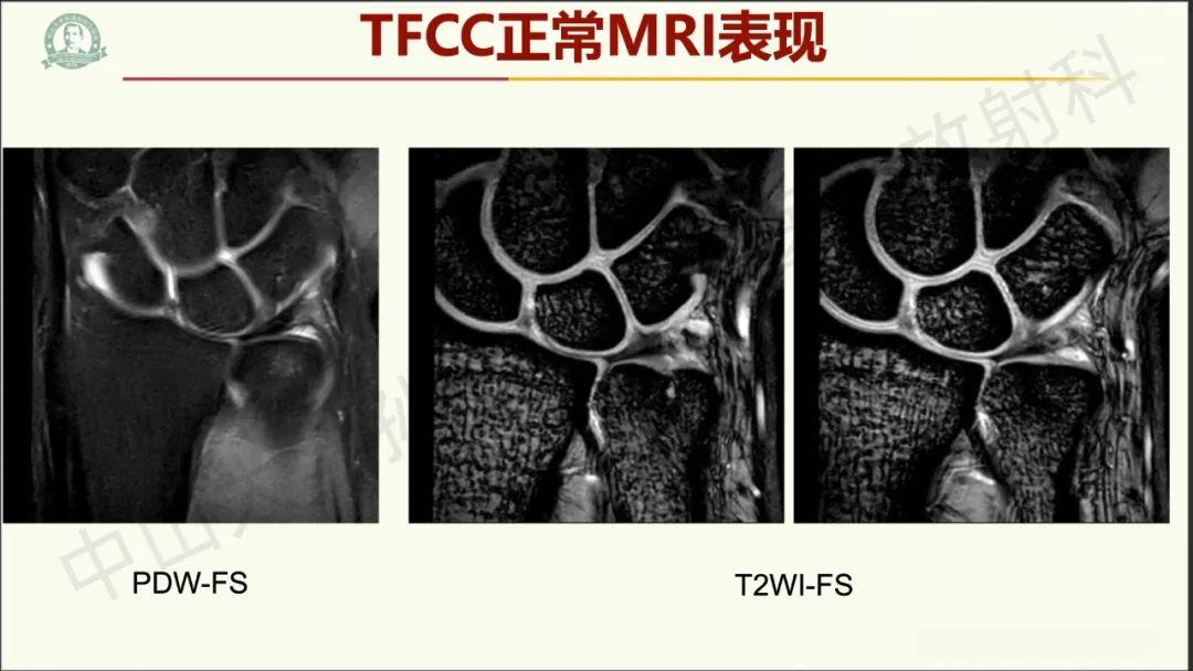 TFCC损伤MRI诊断 - 知乎