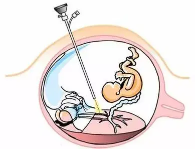 减胎，我应该留下哪个？放弃哪个？ - 知乎