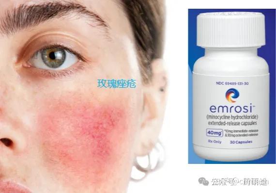 酒糟鼻/玫瑰痤疮口服治疗药物 | 盐酸米诺环素缓释胶囊（Emrosi）获FDA批准上市 - 知乎