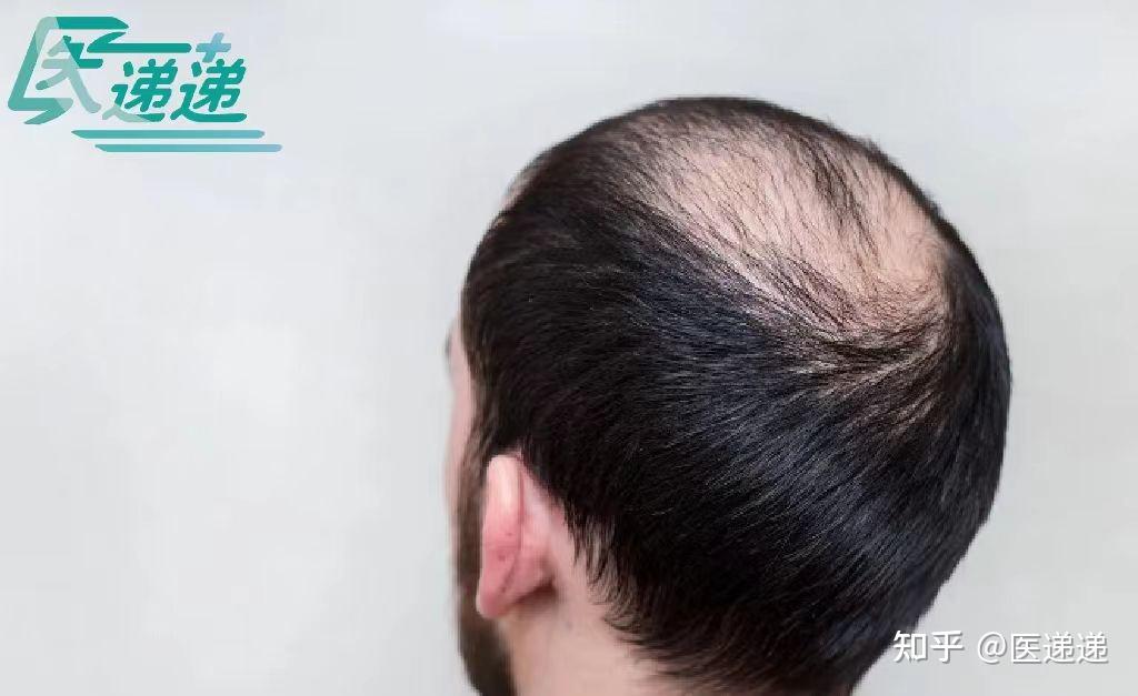 防脱发宝，防脫減掉发 - 知乎