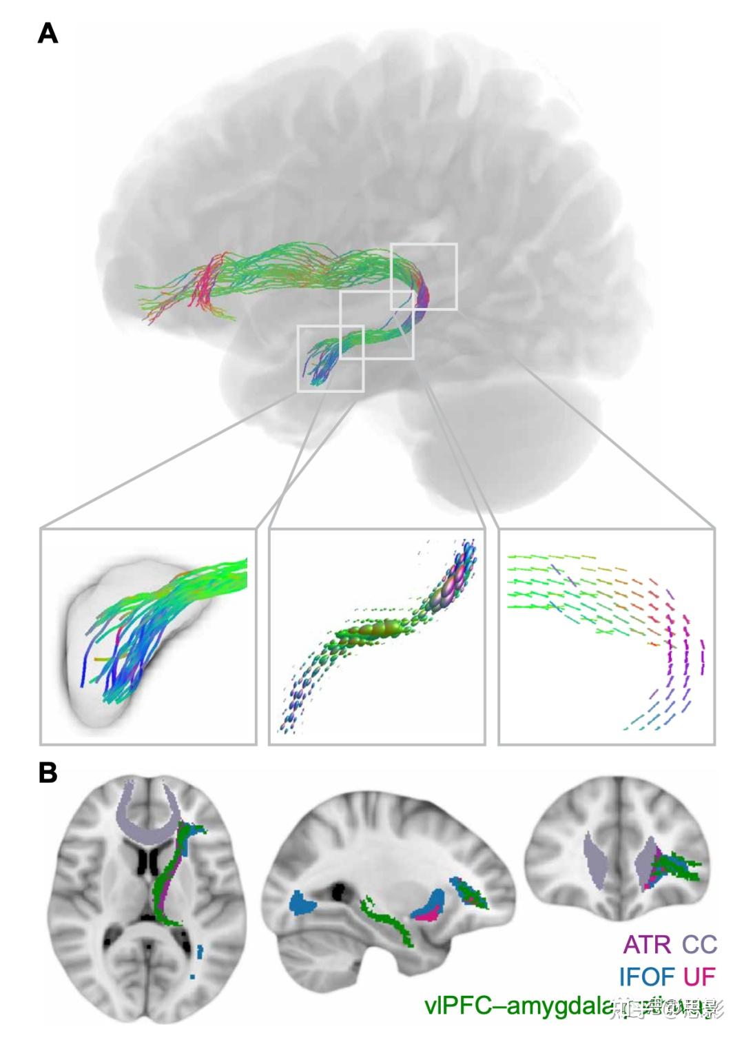 皮层-皮层下结构连接支持经颅磁刺激有效地影响杏仁核 - 知乎