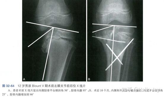胫骨内翻（Blount病） - 知乎