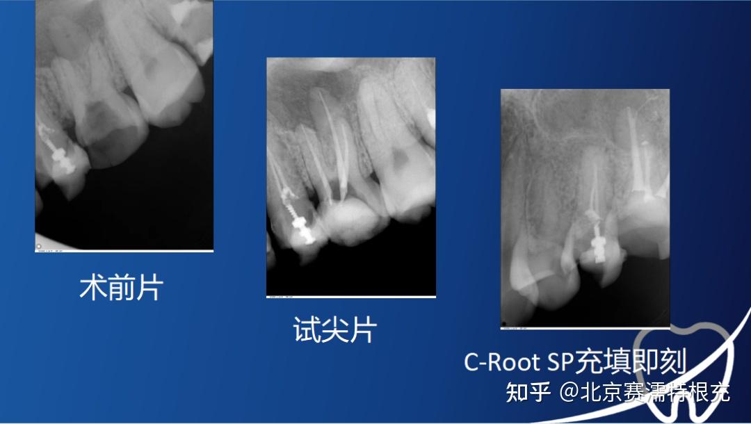 左下第二磨牙根管再治疗一例 | 孙毅医生C-Root SP充填案例分享 - 知乎