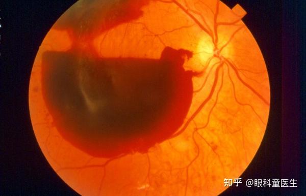 与外伤相关的视网膜病变——7、Terson's 综合征 - 知乎