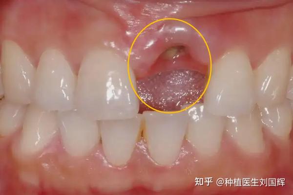 牙科专家揭秘:防止缺牙后牙槽骨继续萎缩的好办法 知乎