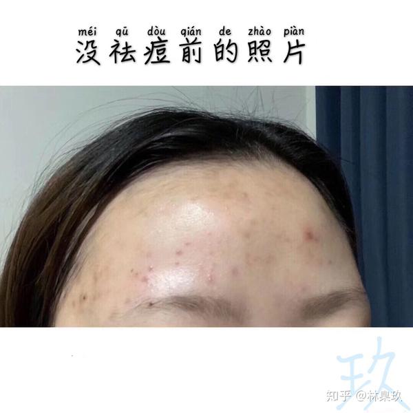 5年的痘痘用30天就能祛掉! 知乎