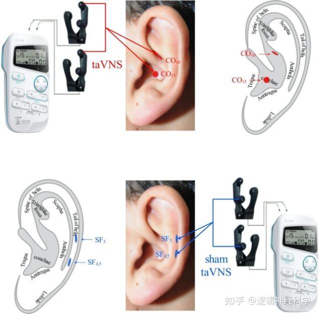 Brain Stimu︱荣培晶课题组提示经皮耳穴电刺激改善轻度认知功能障碍患者的认知功能 - 知乎