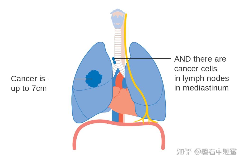 肺癌 Lung cancer - 知乎