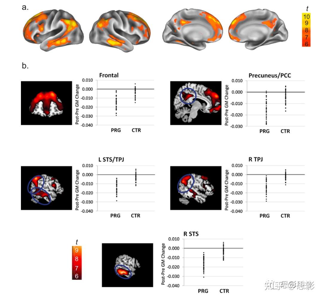 妊娠对静息状态大脑活动、白质微结构、神经代谢物浓度和灰质结构的影响 - 知乎