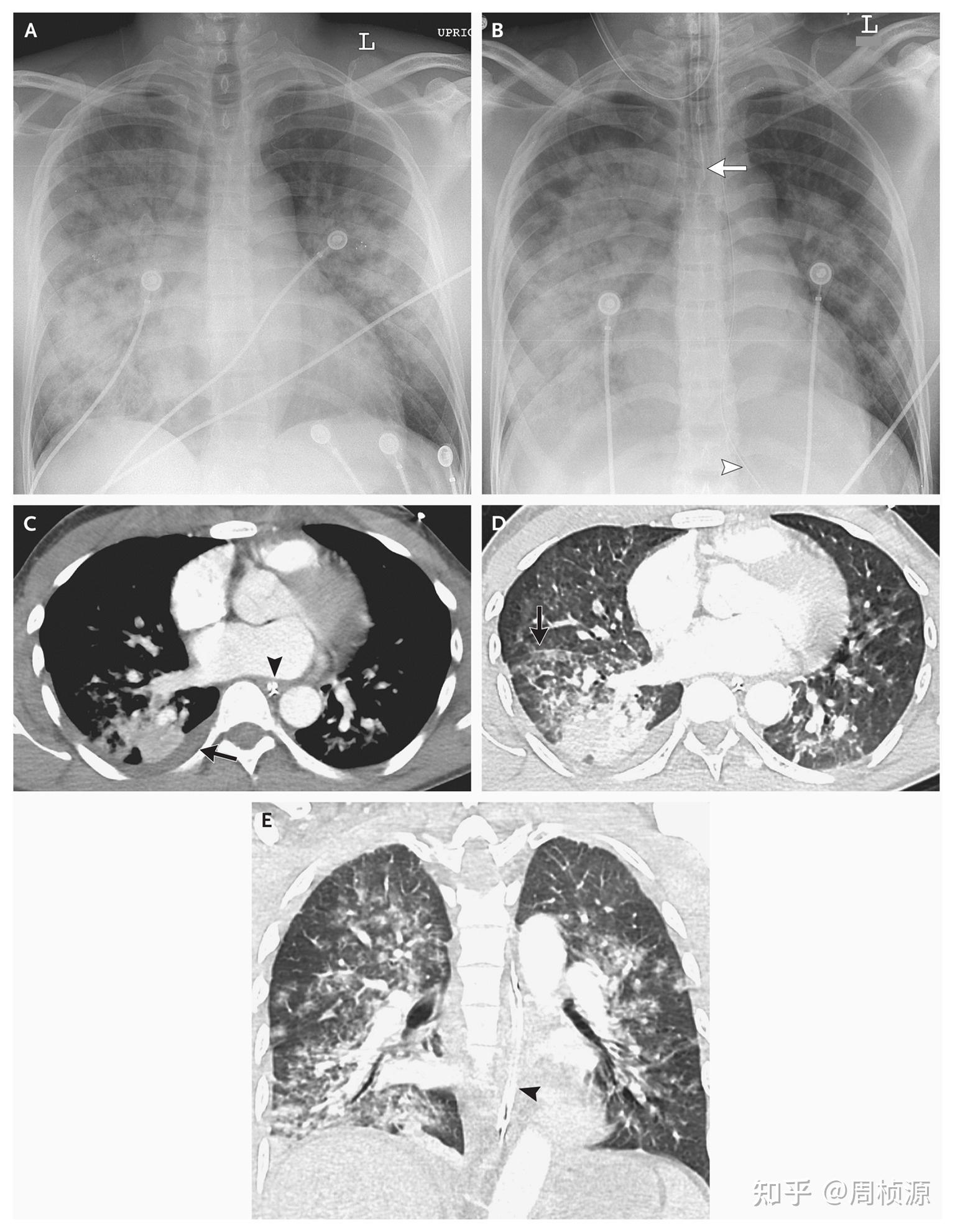 Nejm 2012 Case 32 - 知乎