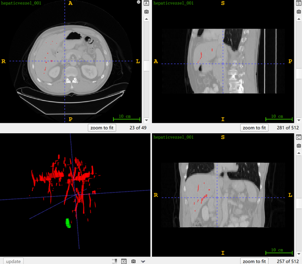 MSD Hepatic Vessel 数据集介绍 - 知乎