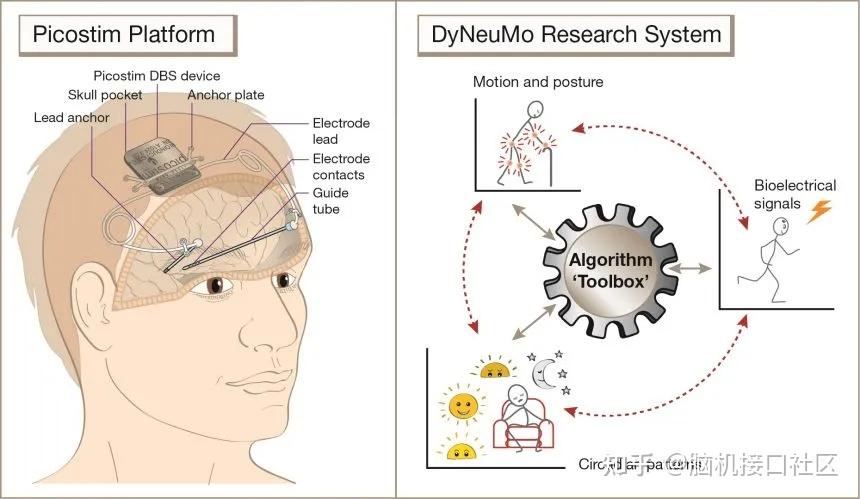 牛津大学的研究人员首次在人体植入“闭环”生物电子研究系统 - 知乎