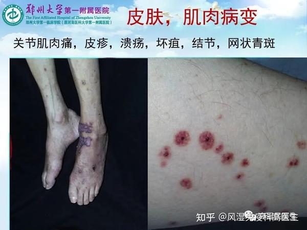 2022年ANCA相关血管炎诊疗进展 - 知乎