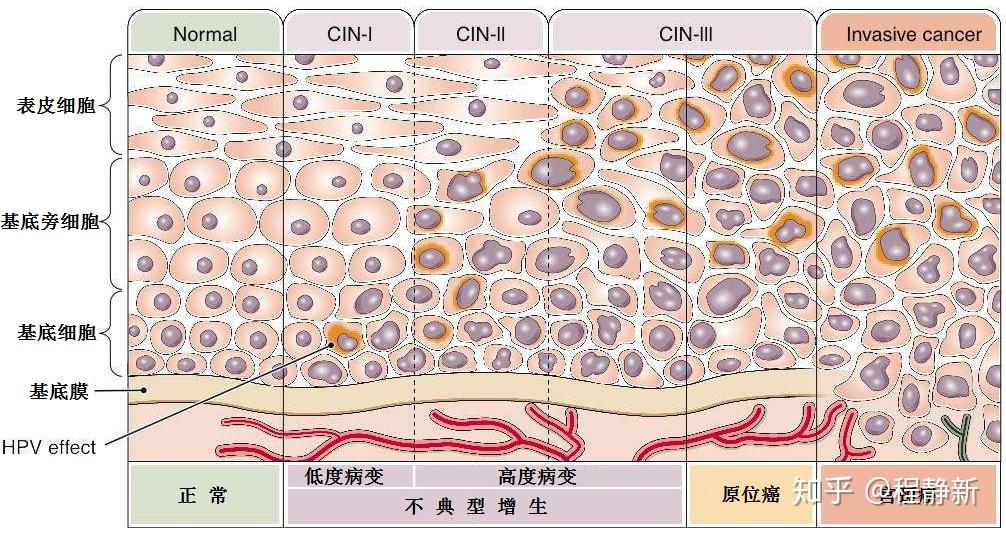TCT、阴道镜、CIN、锥切（leep）都是什么意思？ - 知乎
