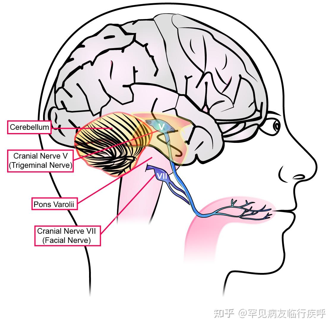 The Portable Neuromodulation Stimulator (PoNS™) Device - 知乎