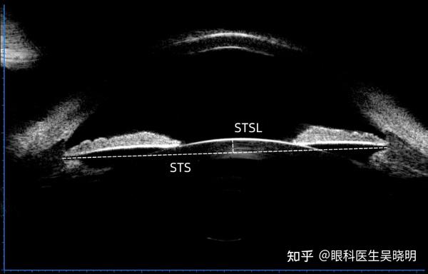 ICL晶体植入术前检查之UBM，为什么术前要做UBM检查？ - 知乎