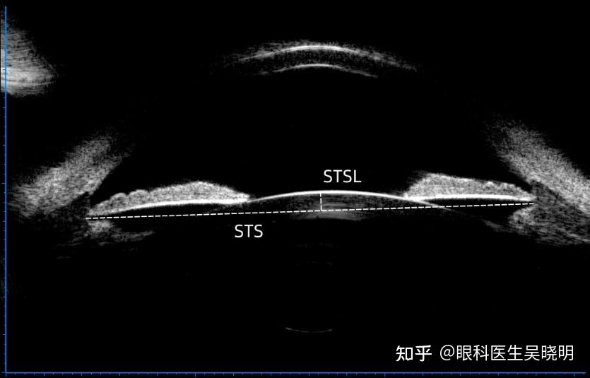 ICL晶体植入术前检查之UBM，为什么术前要做UBM检查？ - 知乎