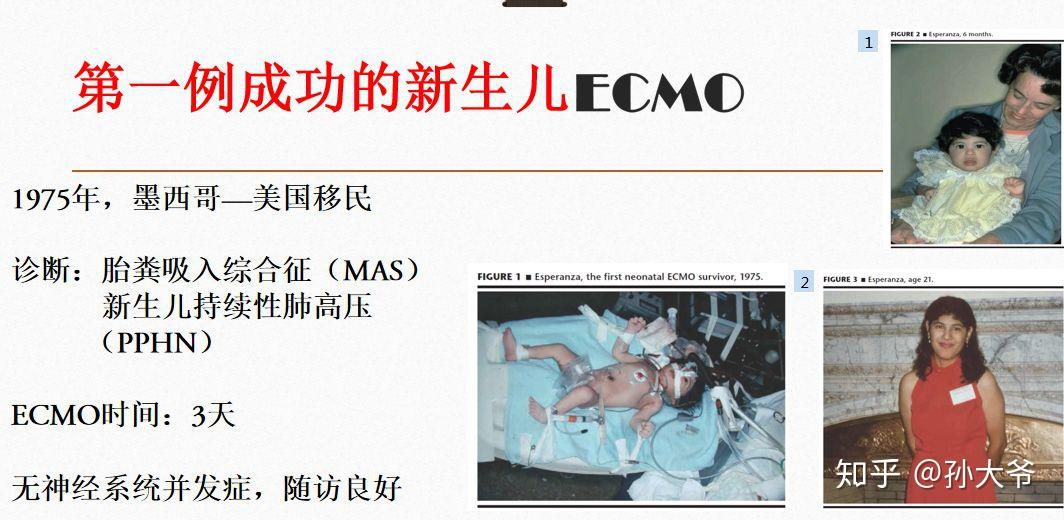 来吧，写个给普通人看的ECMO介绍 - 知乎