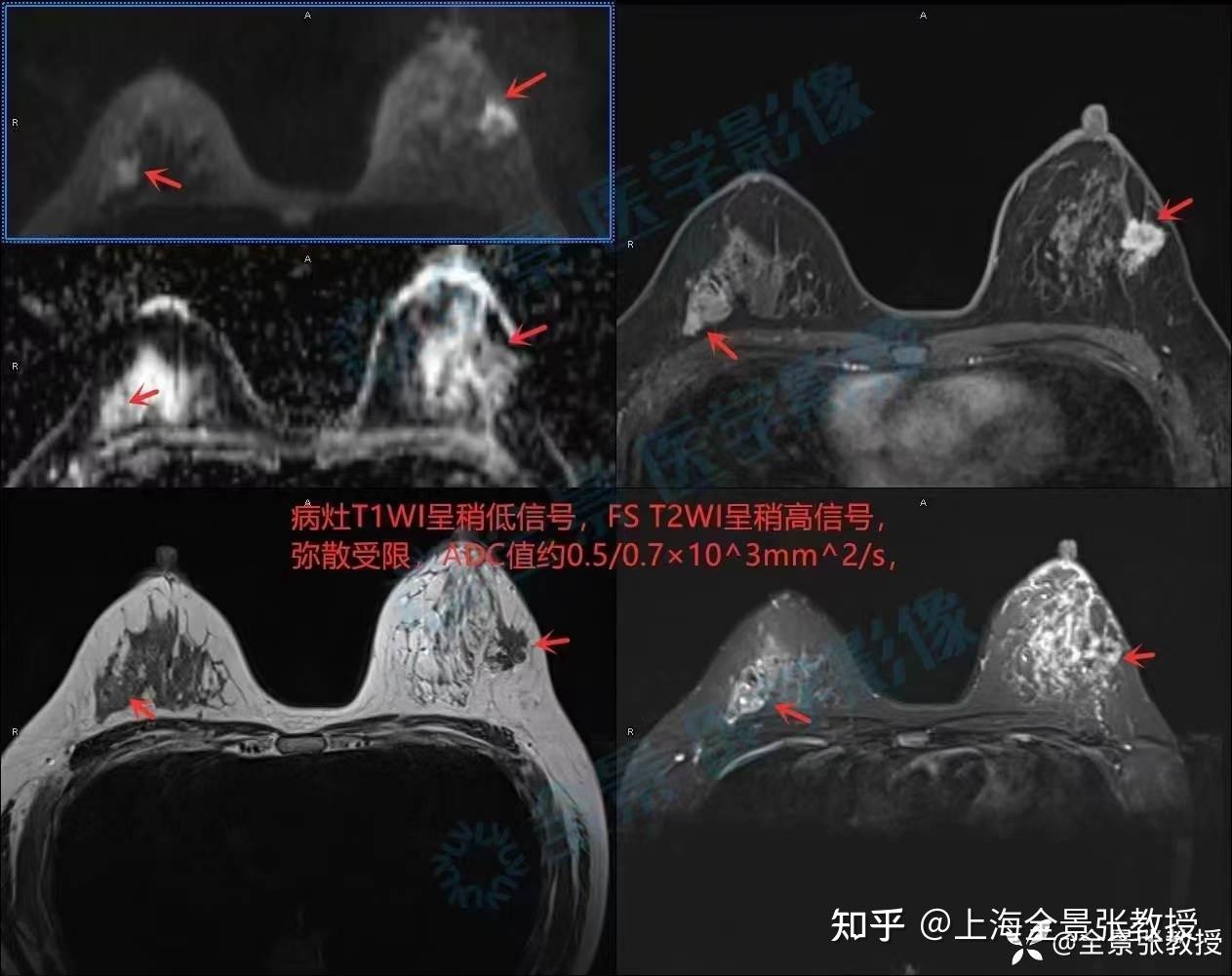 已经做了乳腺彩超和钼靶,为什么还要做乳腺磁共振? 知乎