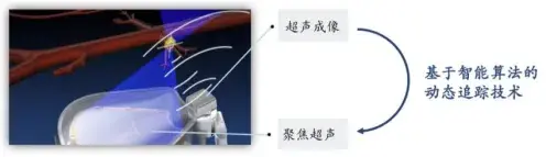 全球唯一高血压专用体外超声RDN设备 - 知乎