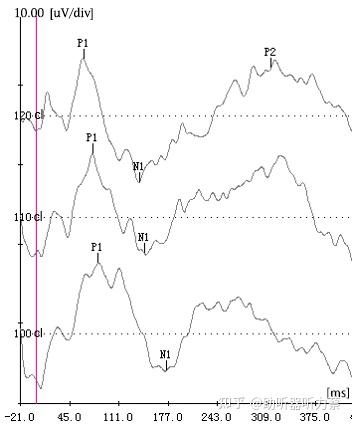 儿童电刺激皮层听觉诱发电位P1-N1-P2的参数优化研究 - 知乎