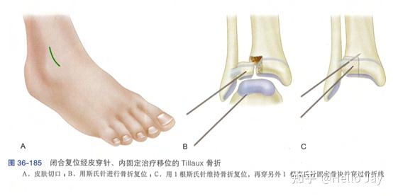 儿童胫腓骨骨折 - 知乎