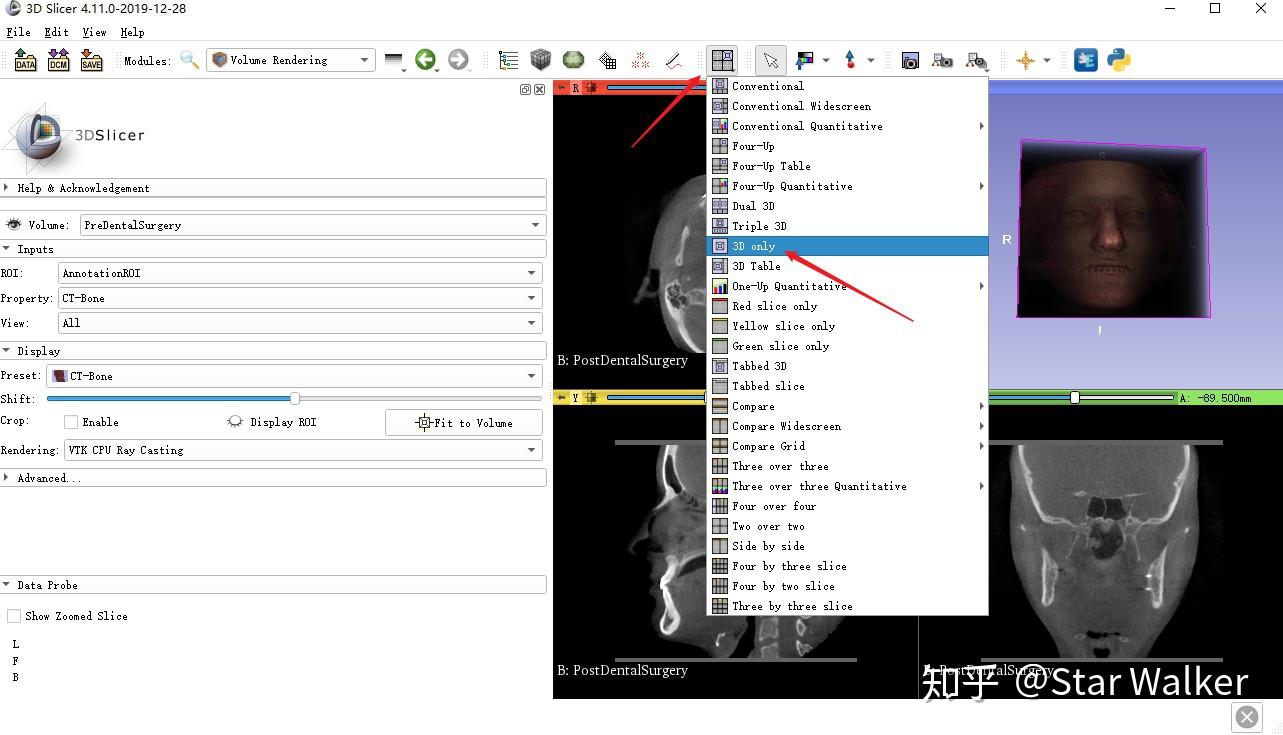 3D Slicer——选择感兴趣区，输出为DICOM序列 - 知乎