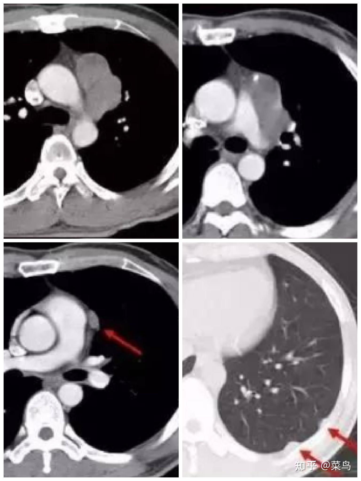 胸腺肿瘤的病理和影像学诊断（胸腺瘤篇） - 知乎