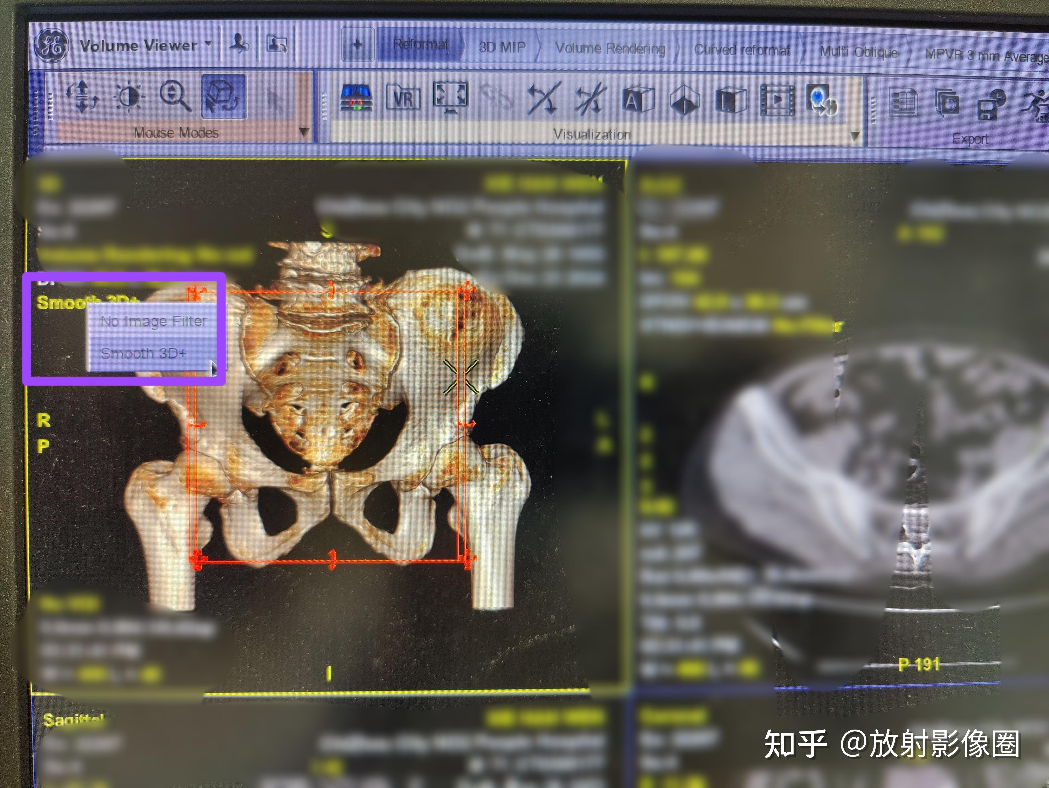 浅谈CT三维重建的操作方法 - 知乎