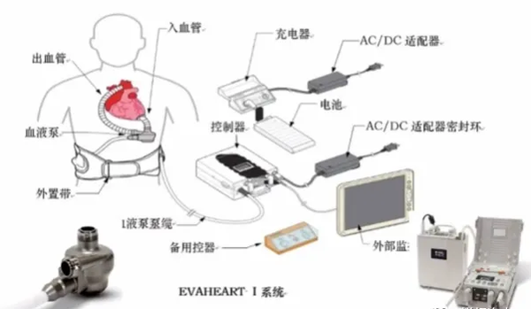 盘点丨为心衰带来希望的LVAD，国内外主流产品有哪些？ - 知乎