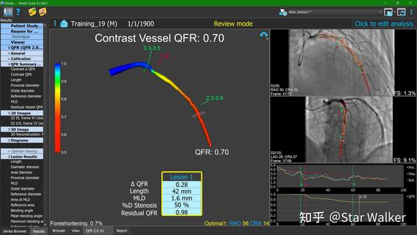 关于冠脉血流储备分数FFR、QFR、FFRCT的简单笔记 - 知乎