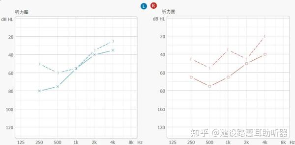 案例分享|ATP1A3耳聋基因致迟发性听神经病（CAPOS综合征） - 知乎
