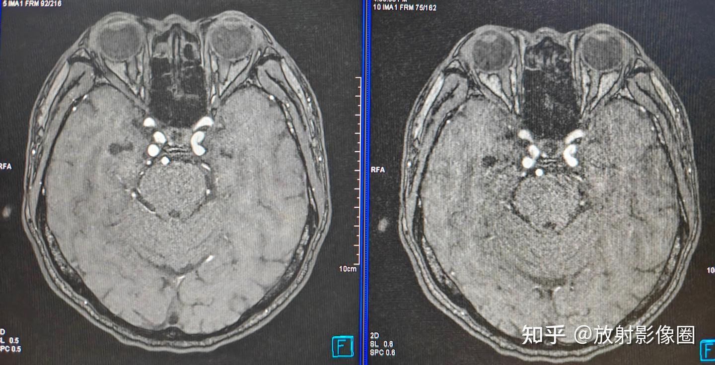 头颅MRA高分辨扫描与普通扫描对比 - 知乎