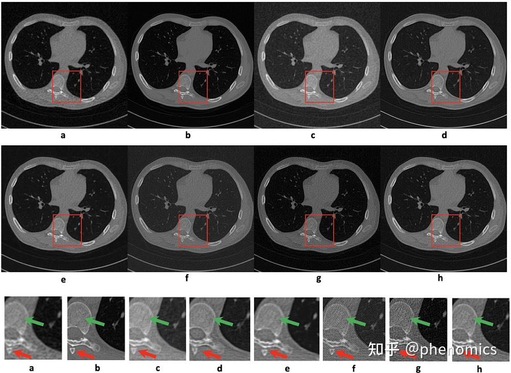 Phenomics| 自监督去噪改善低剂量CT肺结节分类 - 知乎