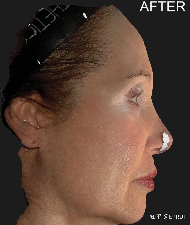 25-45um 医美用CaHA羟基磷灰石微球 - 知乎