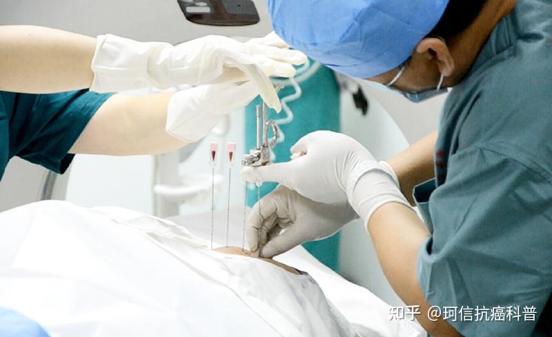 粒子植入后1个月的效果 知乎 7606