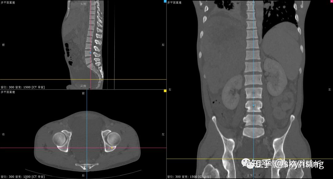 浅谈CT增强技术对影像图片显示质量影响及解决方法并肝脏恶性肿瘤、多发转移报告范例（全文） - 知乎