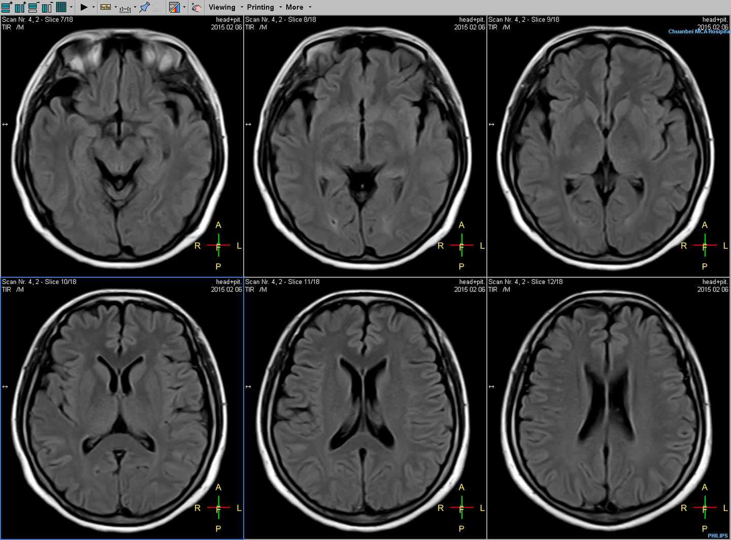 T2 FLAIR序列 - 知乎
