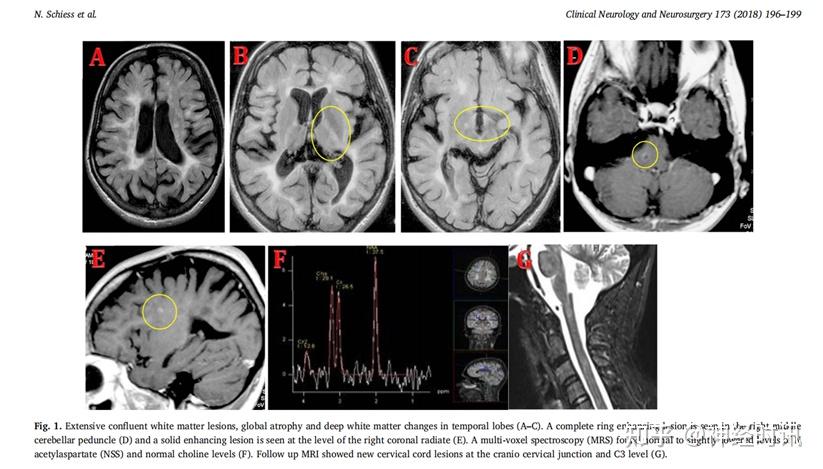 陆正齐教授：淀粉样脑血管病和CADASIL的研究进展 - 知乎
