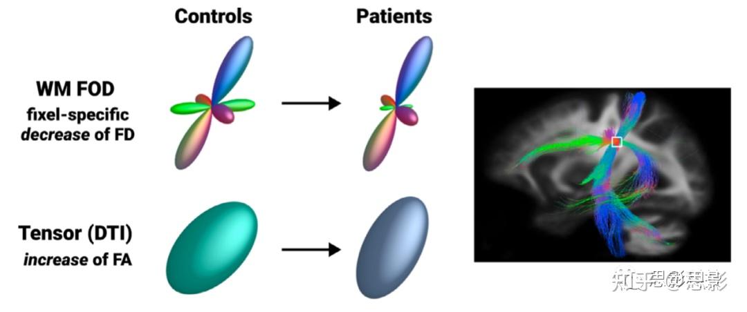 基于扩散磁共振成像的FBA（Fixel-Based Analysis）分析 - 知乎