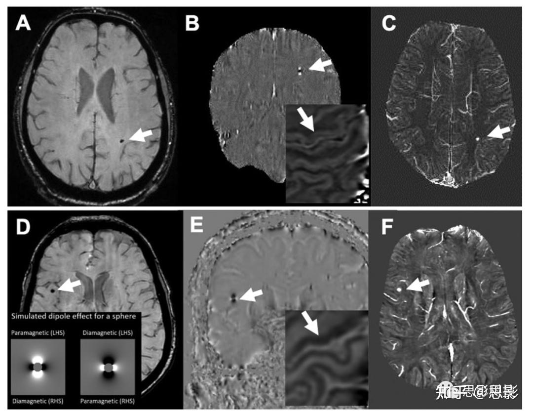 磁敏感加权成像（SWI)：技术要点和临床神经学应用 - 知乎