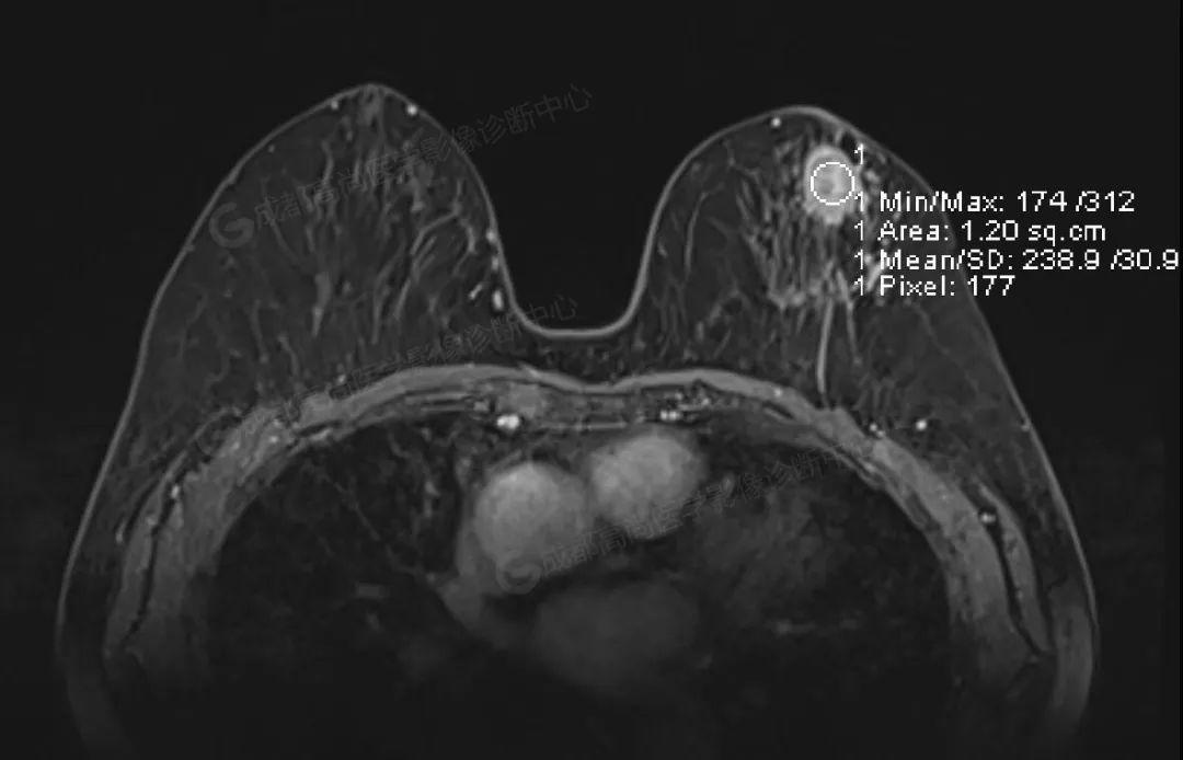 乳腺MR的临床应用 - 知乎